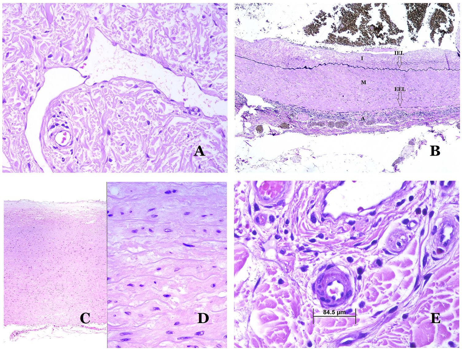 Vascular Malformations: A Histopathologic and Conceptual Appraisal ...