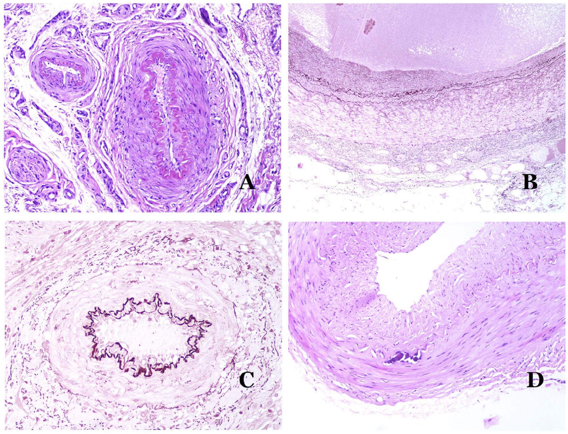 [Artículo traducido] Malformaciones vasculares: un enfoque ...