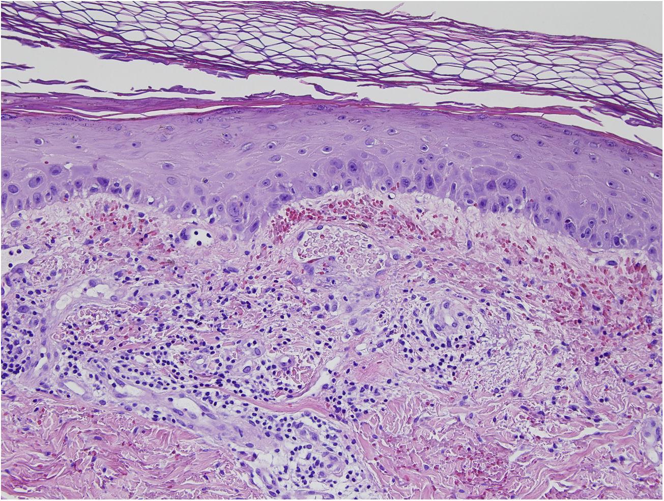 Eritema ab igne: correlación clínico-patológica en una serie de 5 ...