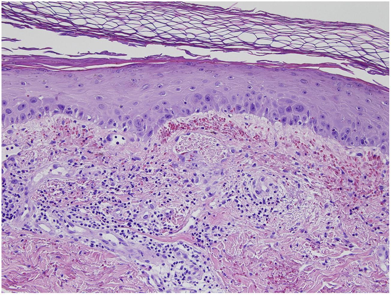 [Translated article] Clinicopathologic Correlations in Erythema ab Igne ...