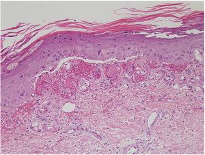 [Translated article] Clinicopathologic Correlations in Erythema ab Igne ...