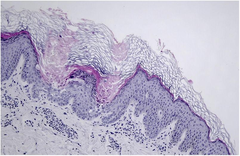 Papular Lesions With Blaschkoide Distribution in a 51-Year-Old Male ...