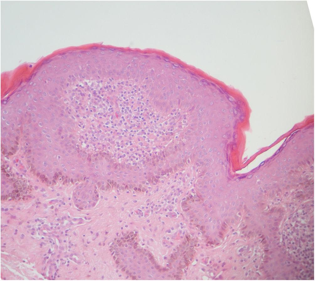Pápulas peneanas de aparición progresiva | Actas Dermo-Sifiliográficas