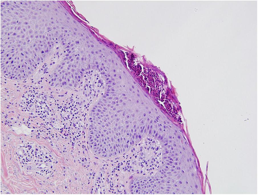 New-Onset Psoriatic Erythroderma Related to COVID-19: A Virus-Mediated ...