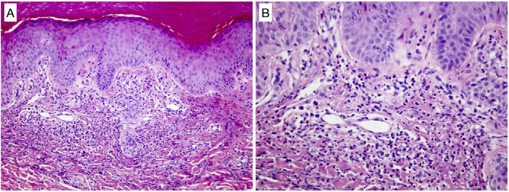 [Translated article] Janeway-Like Lesions Associated With Sepsis ...
