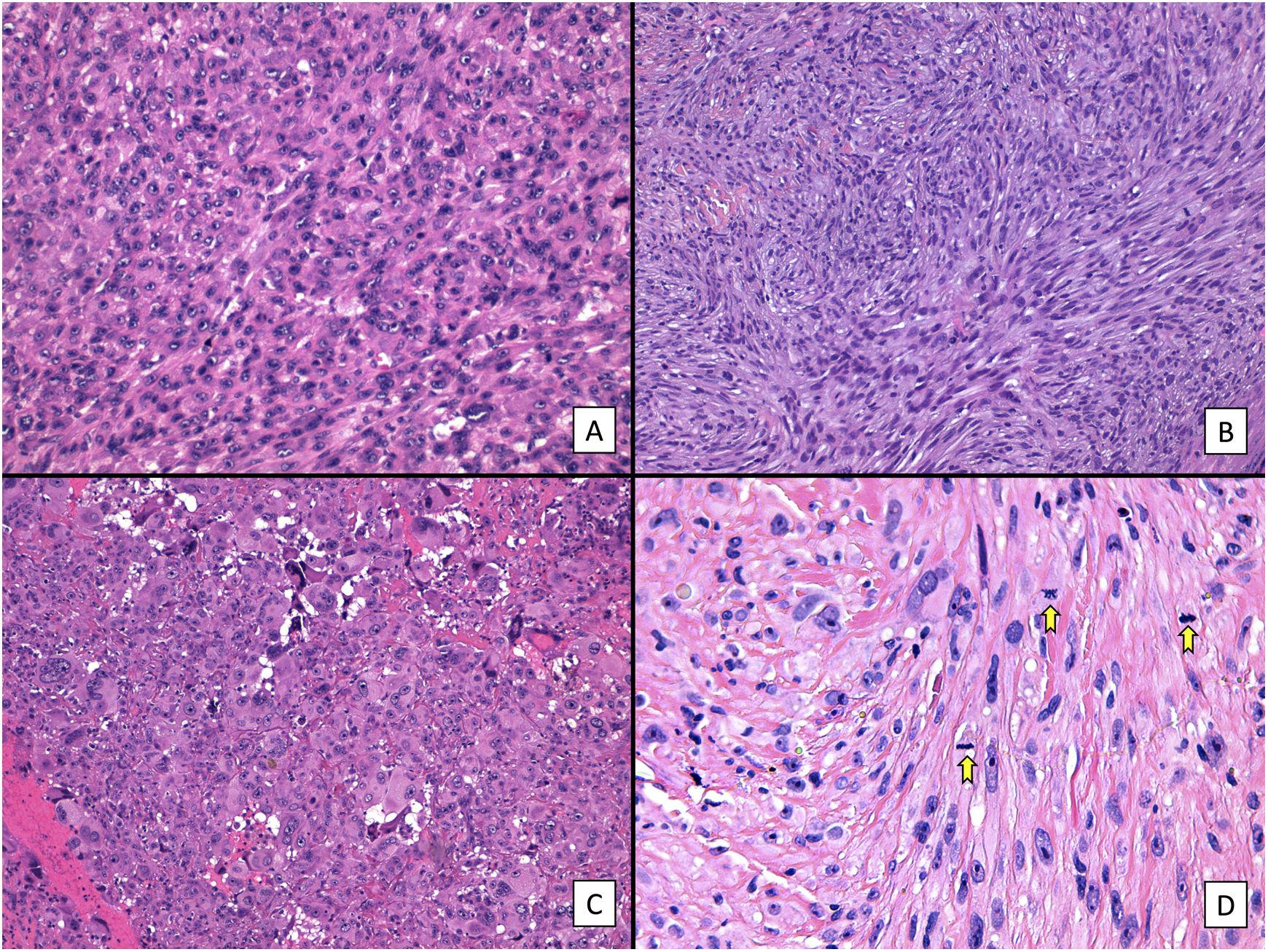 La presencia de infiltración linfovascular y de un alto número de ...