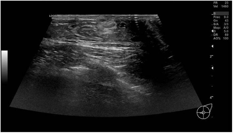[Translated article] Breast Mass in an Adolescent Boy | Actas Dermo ...