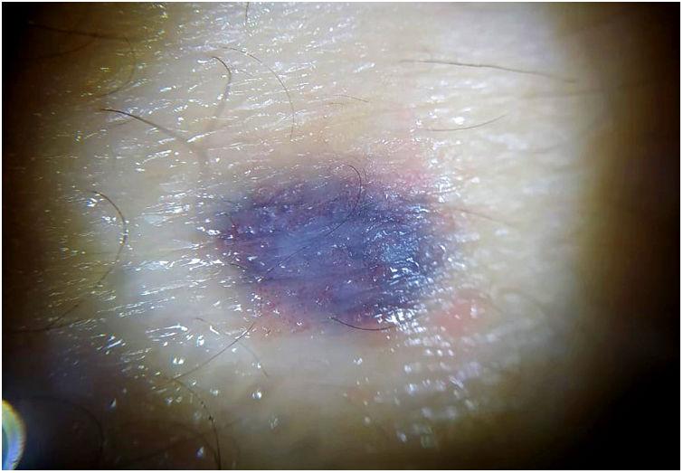 Placa azul solitaria: más allá del patrón azul homogéneo | Actas Dermo ...