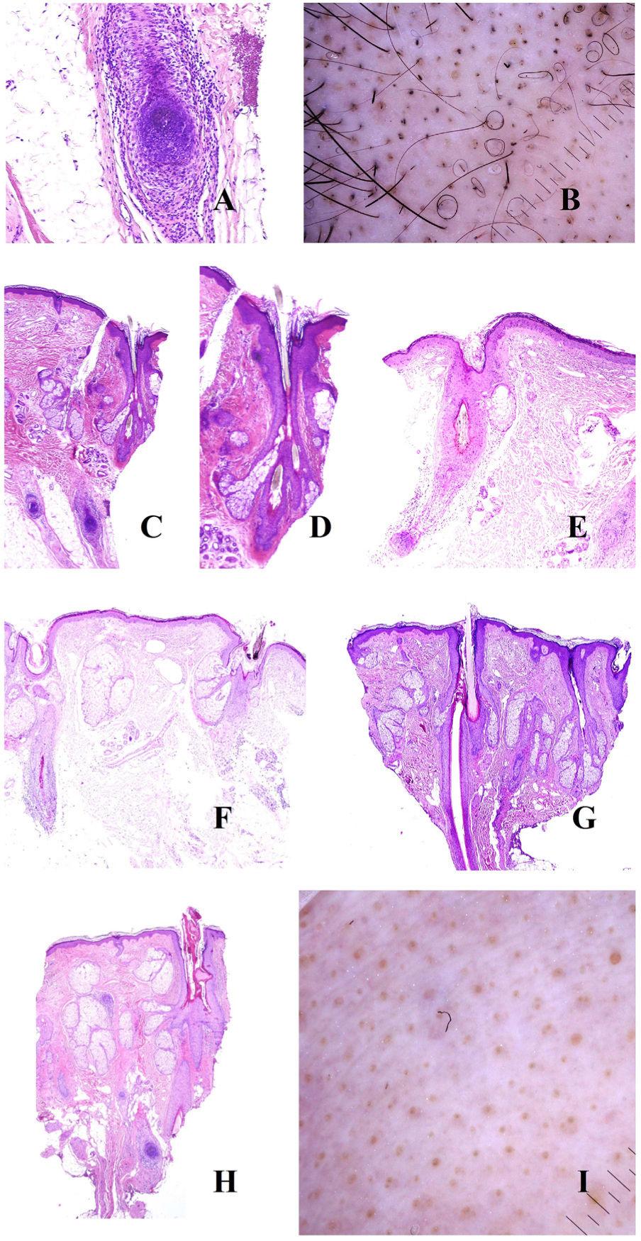 [Translated article] Histopathologic and Trichoscopic Correlations in ...