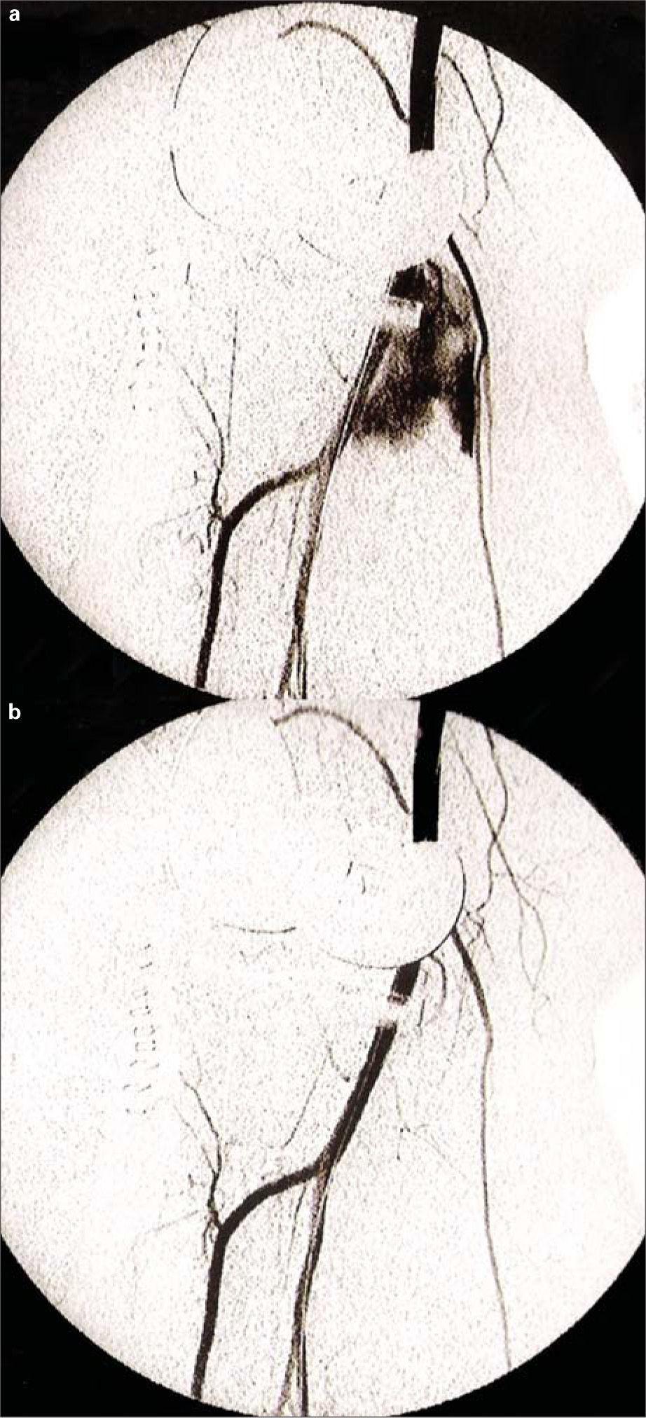 Pseudoaneurisma de la arteria poplítea como complicación de la cirugía ...