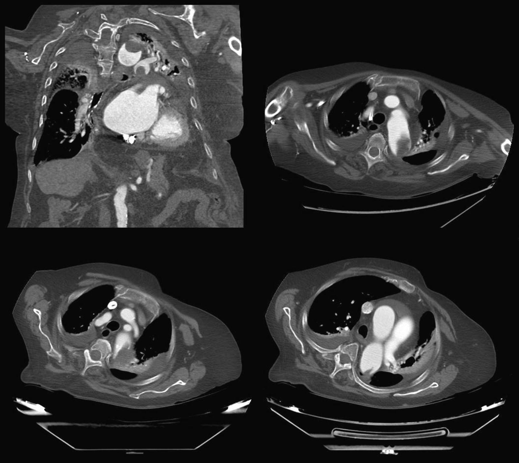 Tratamiento endovascular con stent no cubierto en el trombo flotante ...