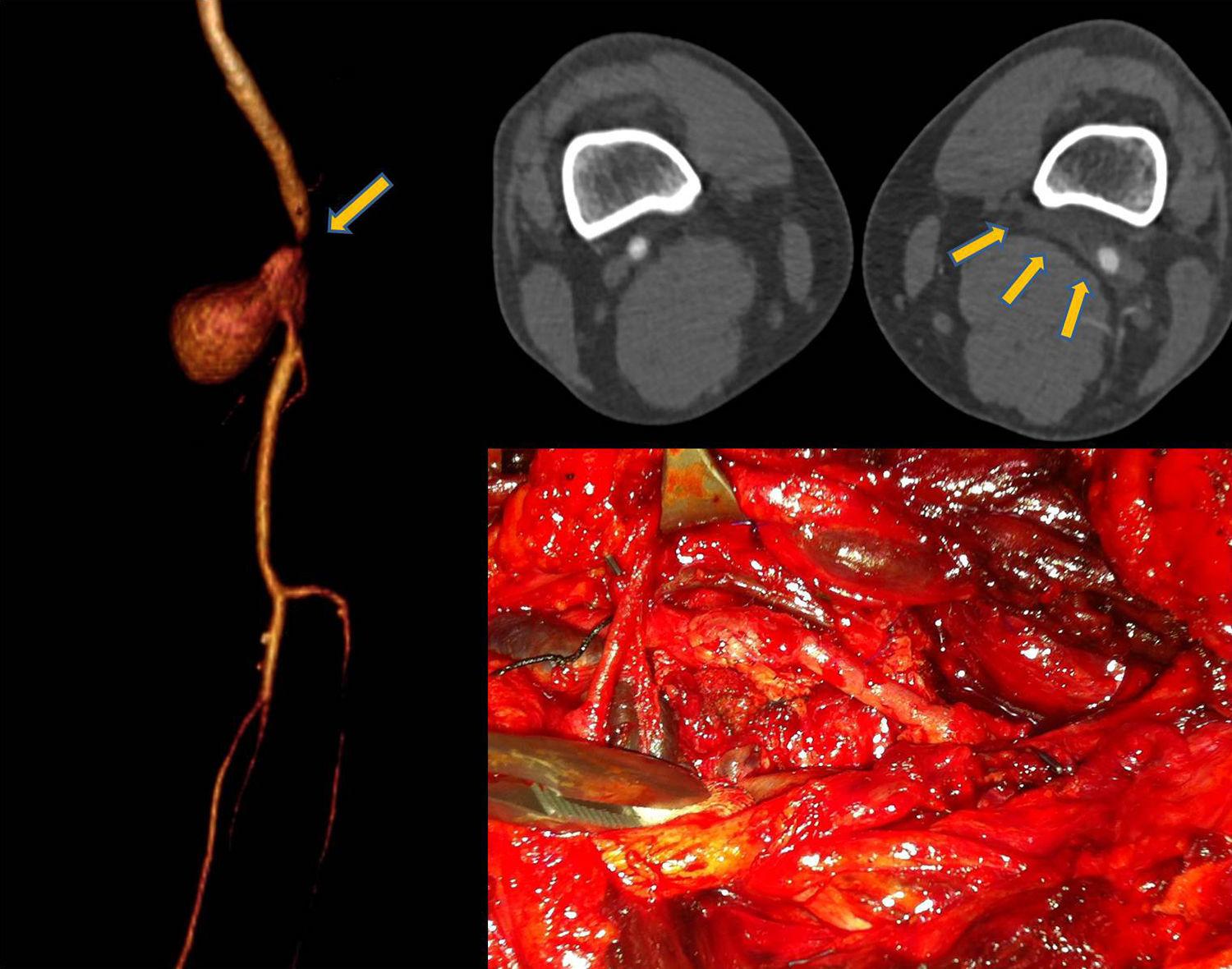 Degeneración aneurismática de la arteria poplítea por síndrome de ...