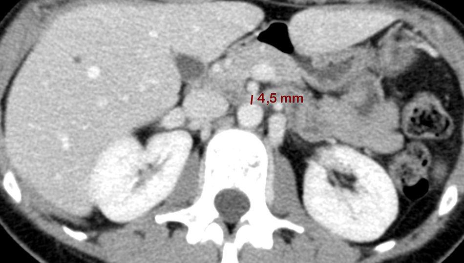 Caso 15. Angina intestinal de causa no ateroesclerótica en mujer joven ...