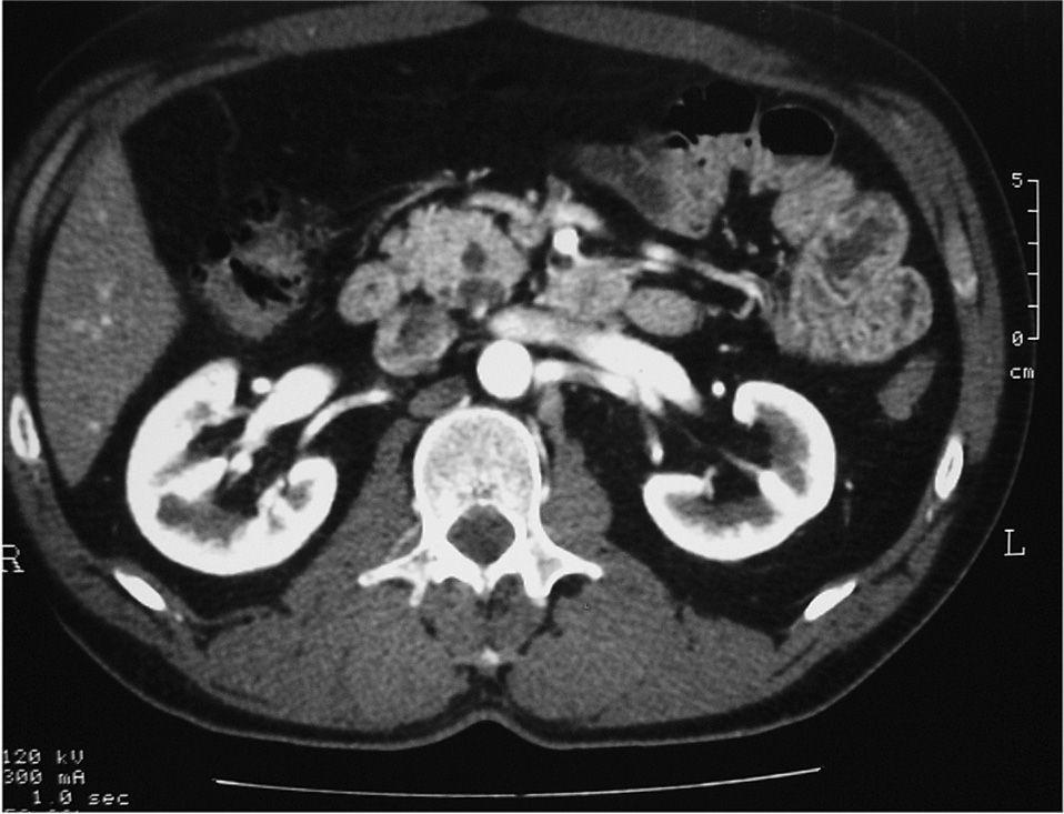 Neoplasias quísticas del páncreas. Manejo diagnóstico y terapéutico ...