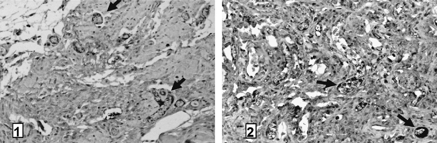 Fijación con sutura frente a sellante de fibrina en hernioplastia con ...
