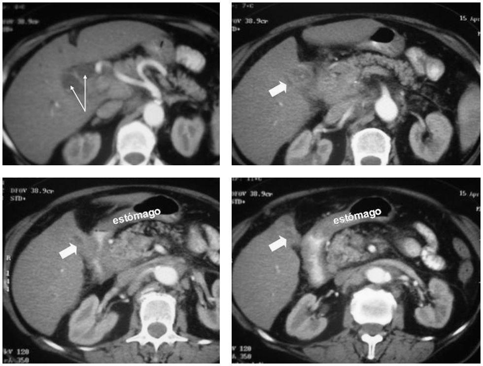 Cáncer de vesícula biliar en un hospital comarcal | Cirugía Española