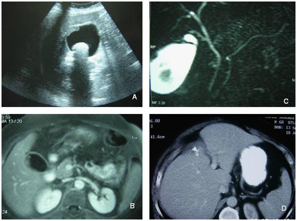 Cáncer de vesícula biliar en un hospital comarcal | Cirugía Española
