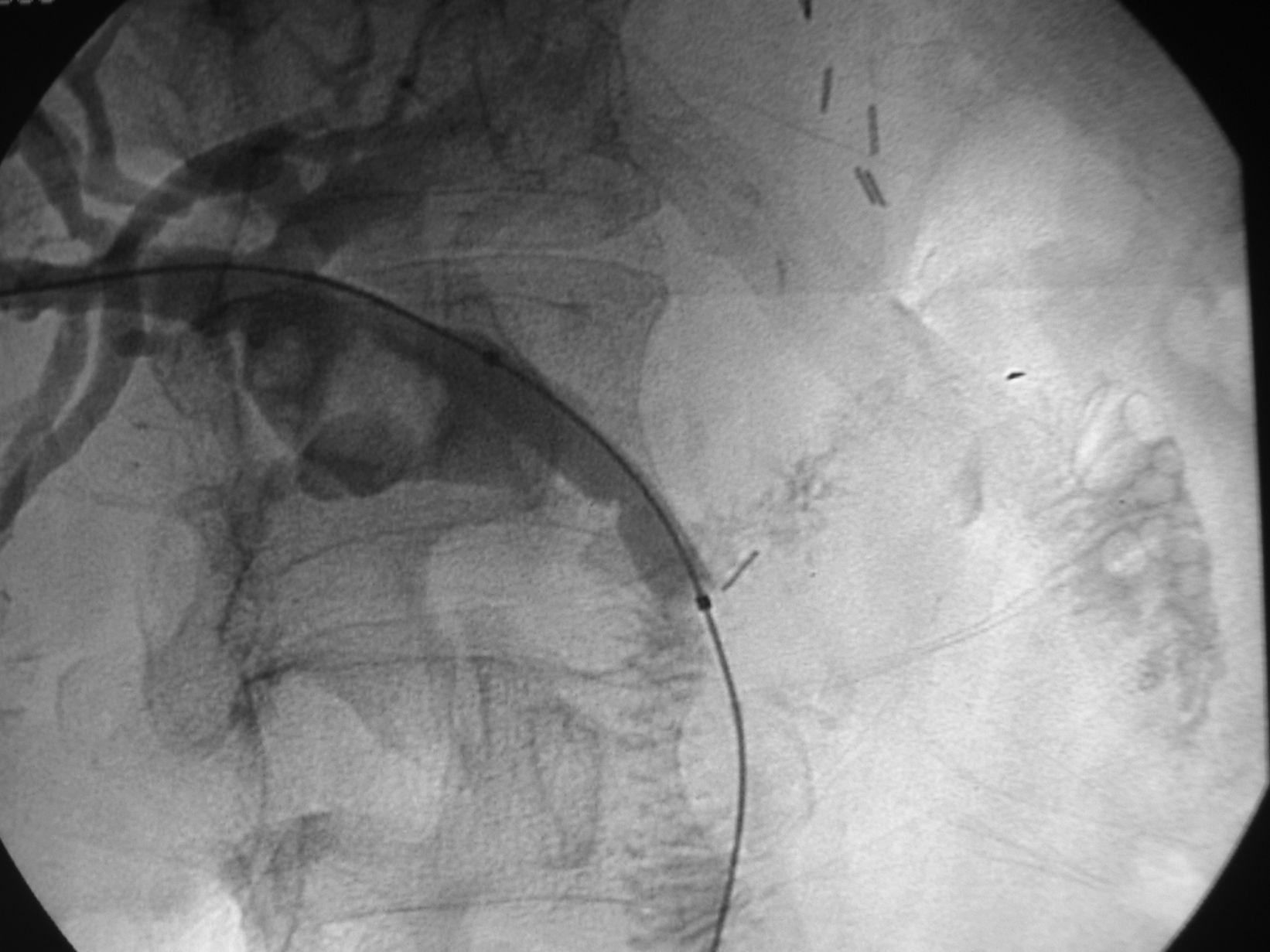 Dilatación transparietohepática de estenosis biliar benigna ...