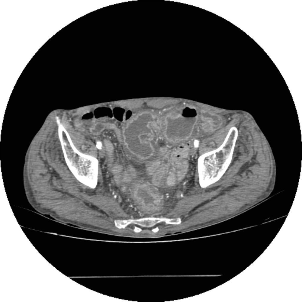 Colitis fulminante por Clostridium difficile | Cirugía Española