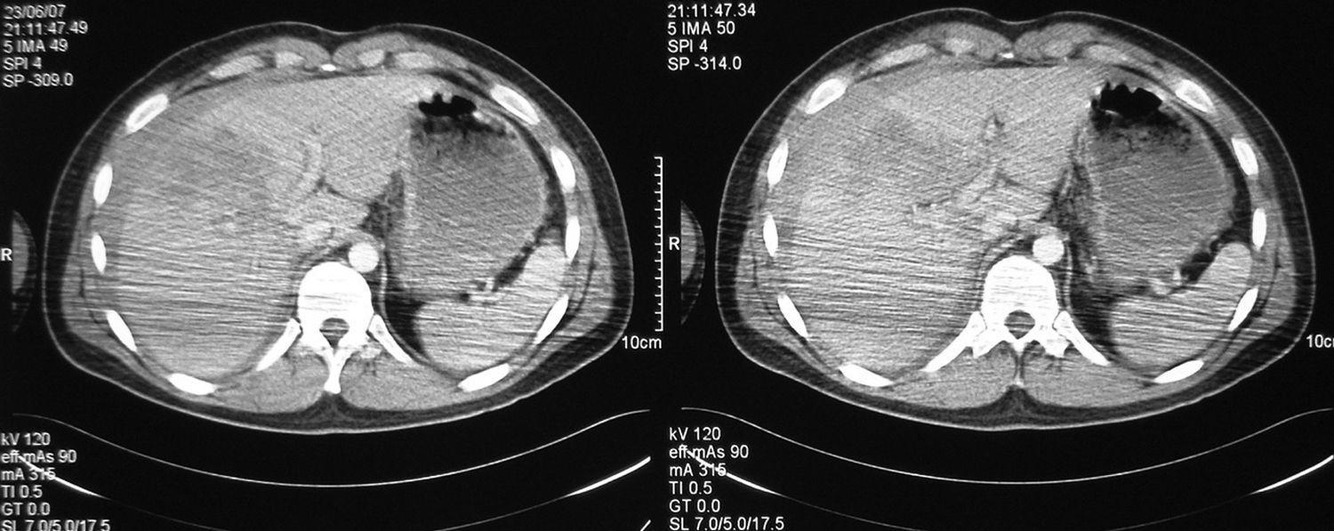 Manejo del traumatismo hepático: cuatro años de experiencia | Cirugía ...