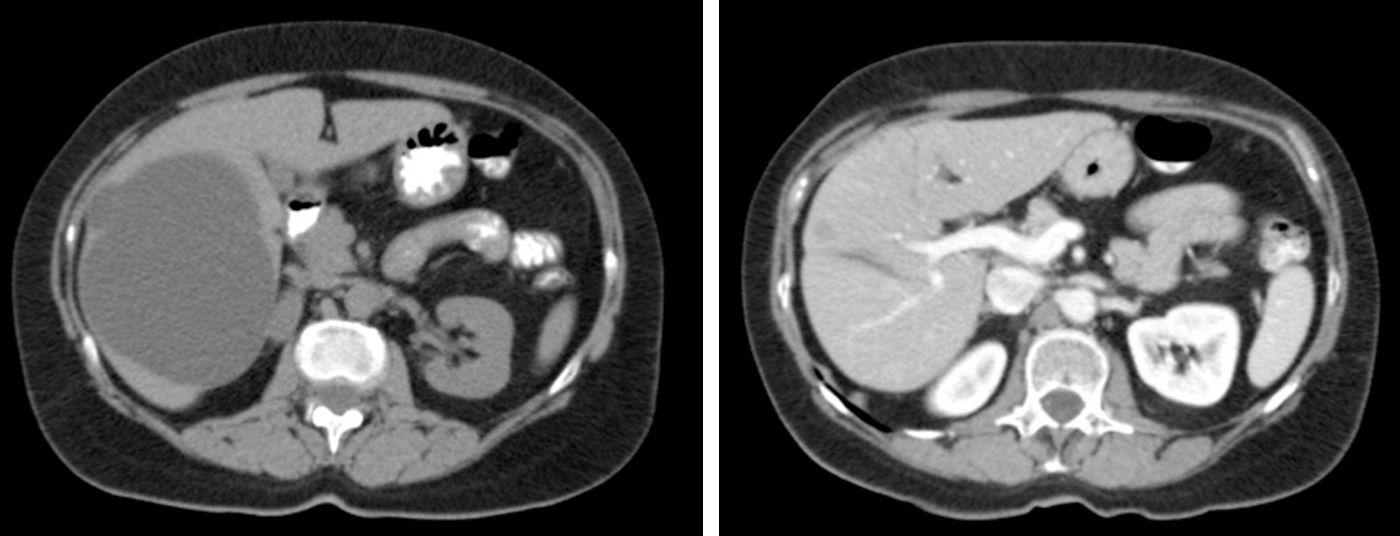 Tumores hepáticos quísticos benignos no parasitarios | Cirugía Española