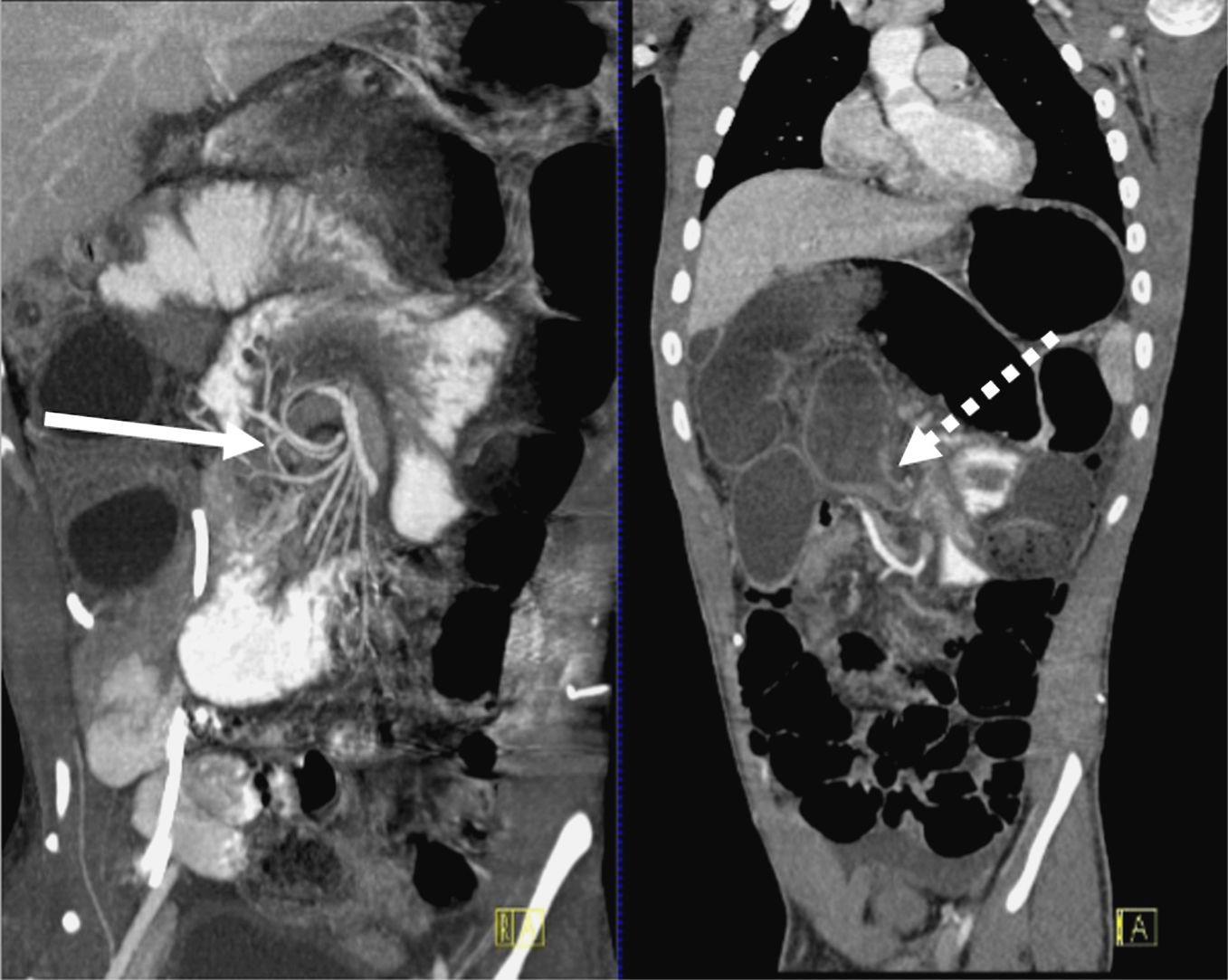 Obstrucción intestinal secundaria a bridas: signo de Whirpool | Cirugía ...