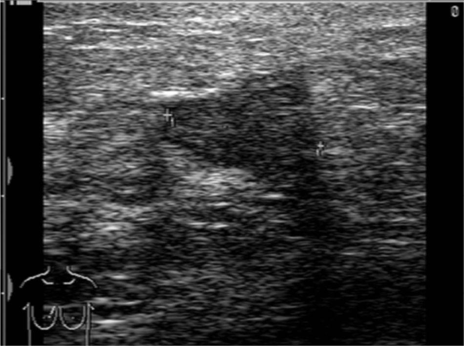 Mastitis granulomatosa idiopática. Una entidad sin tratamiento ...
