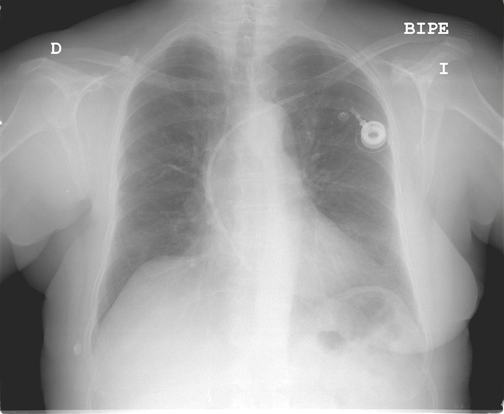 Rotura y migración de catéter de reservorio en vena subclavia | Cirugía ...