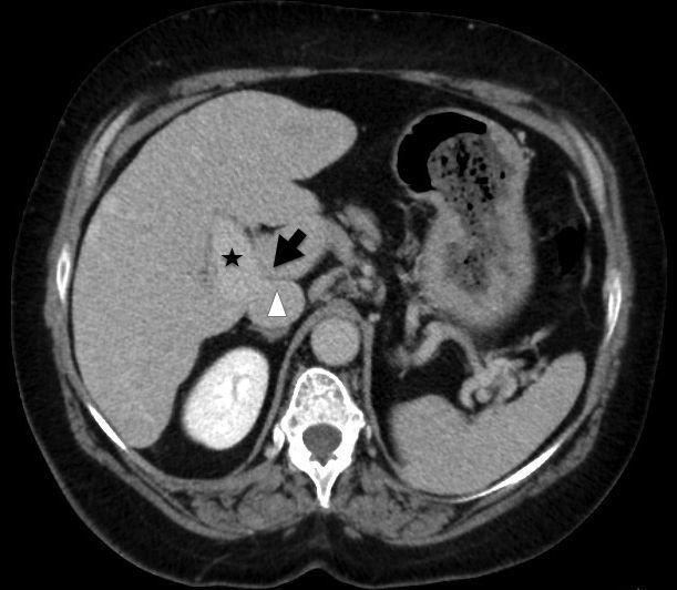 Shunt portocava o malformación de Abernethy | Cirugía Española