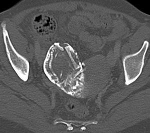 Litopedion | Cirugía Española