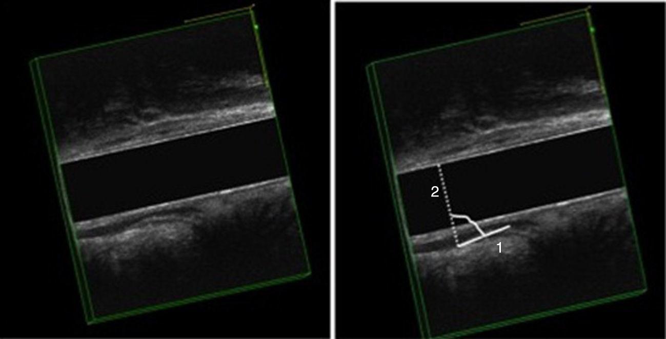Utilidad de la ecografía dinámica tridimensional en el estudio del ...