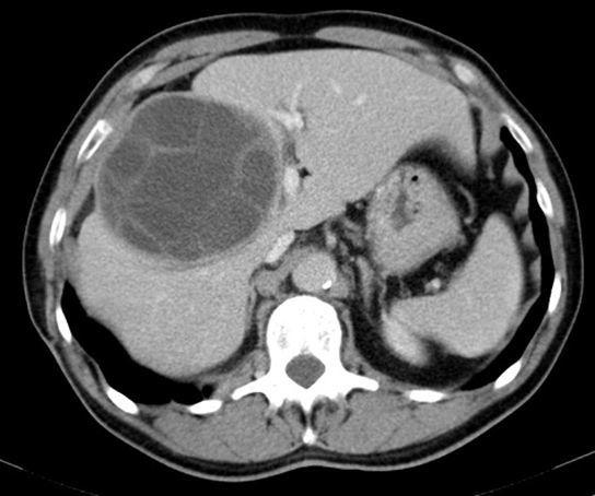 Vaciamiento de quiste hidatídico hepático a través de trocar de ...
