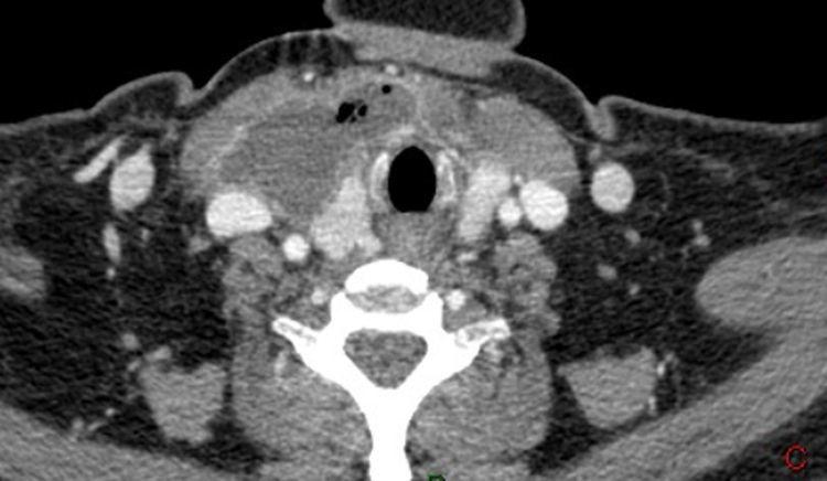 Absceso mamario y sepsis con origen en infección oral | Cirugía Española