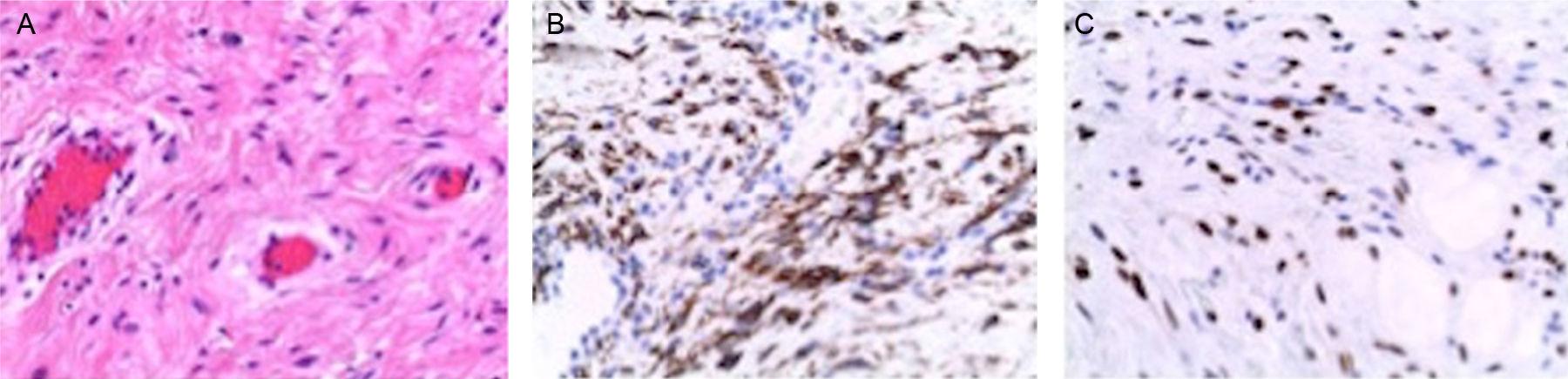 Angiomixoma agresivo. Un raro tumor mesenquimal pélvico | Cirugía Española