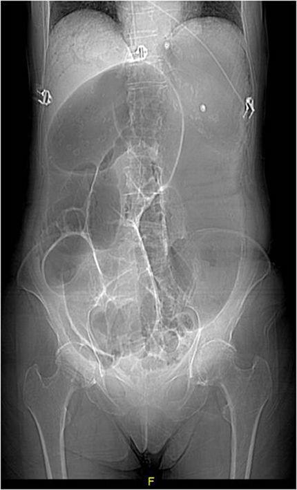 Isquemia masiva de colon secundaria a vólvulo de sigma | Cirugía Española