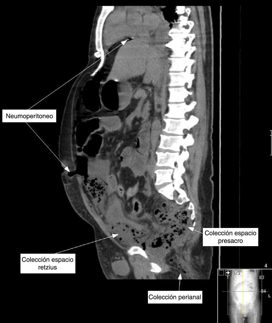 Absceso isquiorrectal con extensión intra y preperitoneal | Cirugía ...