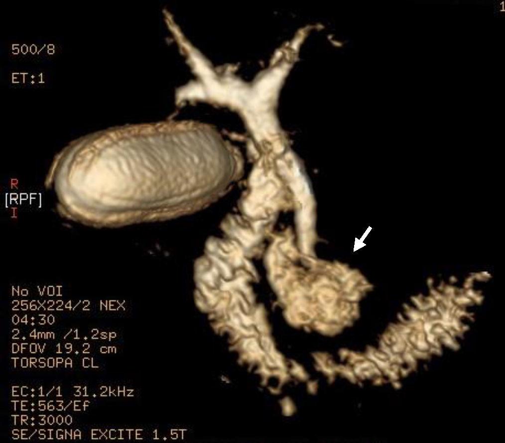 Síndrome de Lemmel: ictericia obstructiva secundaria a divertículo ...