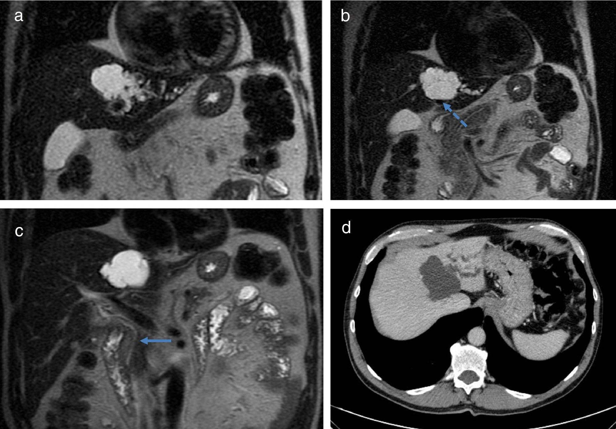 Neoplasia papilar intraductal de la vía biliar: un reto diagnóstico ...