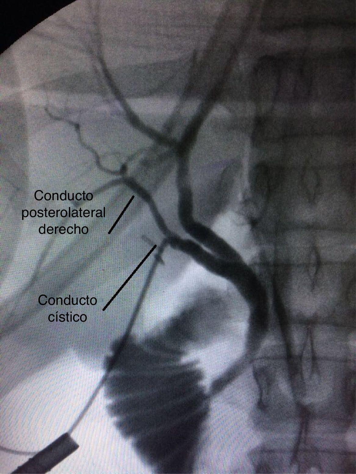 Colangiografía: variante anatómica poco frecuente de la vía biliar ...