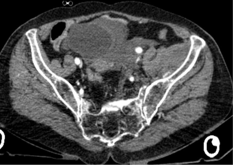 Fracturas de pelvis con hematoma retroperitoneal asociado: tiempo hasta ...