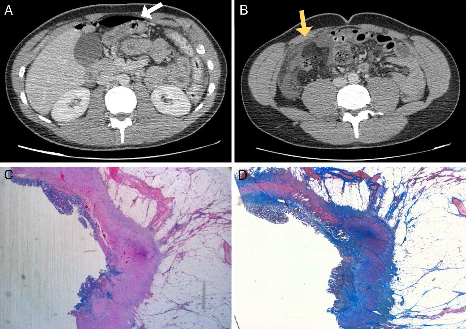 Traumatismo abdominal leve en pacientes con enfermedad de Crohn: ¿mayor ...