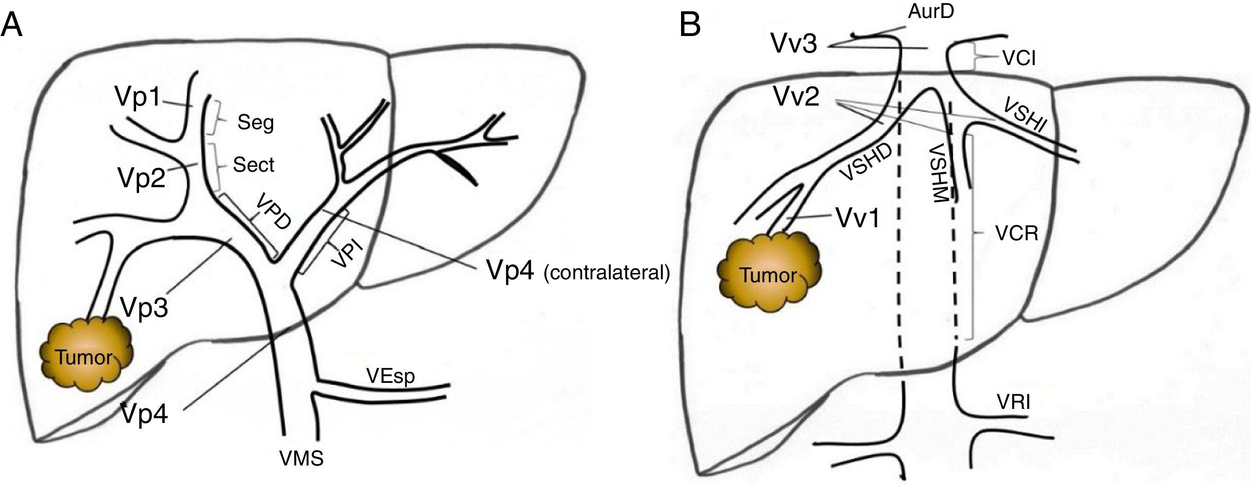 Resección hepática con trombectomía en el tratamiento del carcinoma ...