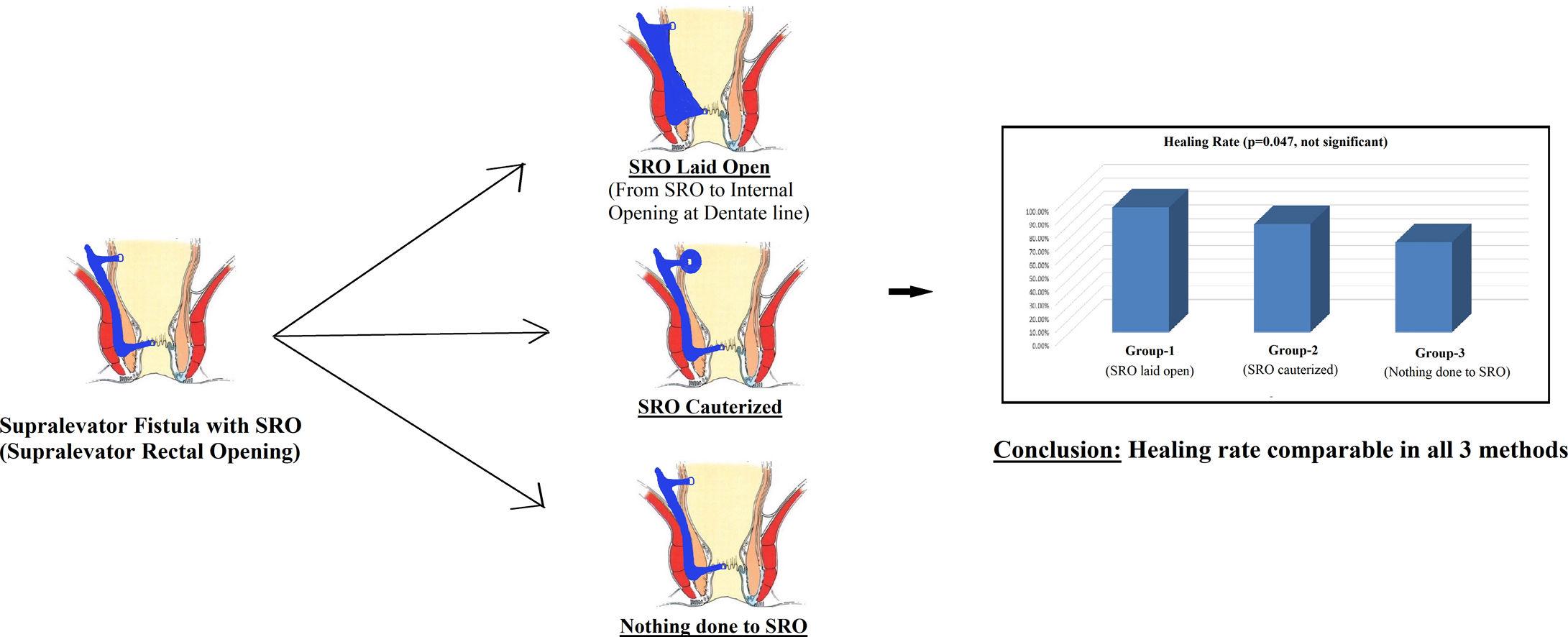 Comparison of different methods to manage supralevator rectal opening ...