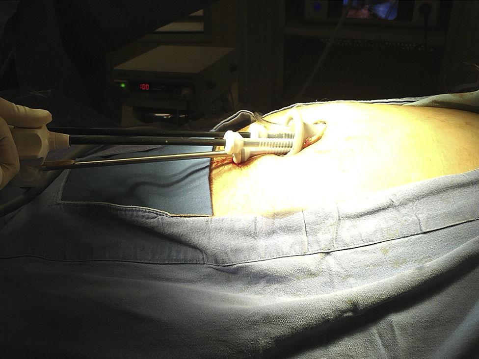 Drenaje de absceso hepático amebiano por laparoscopia de puerto único ...