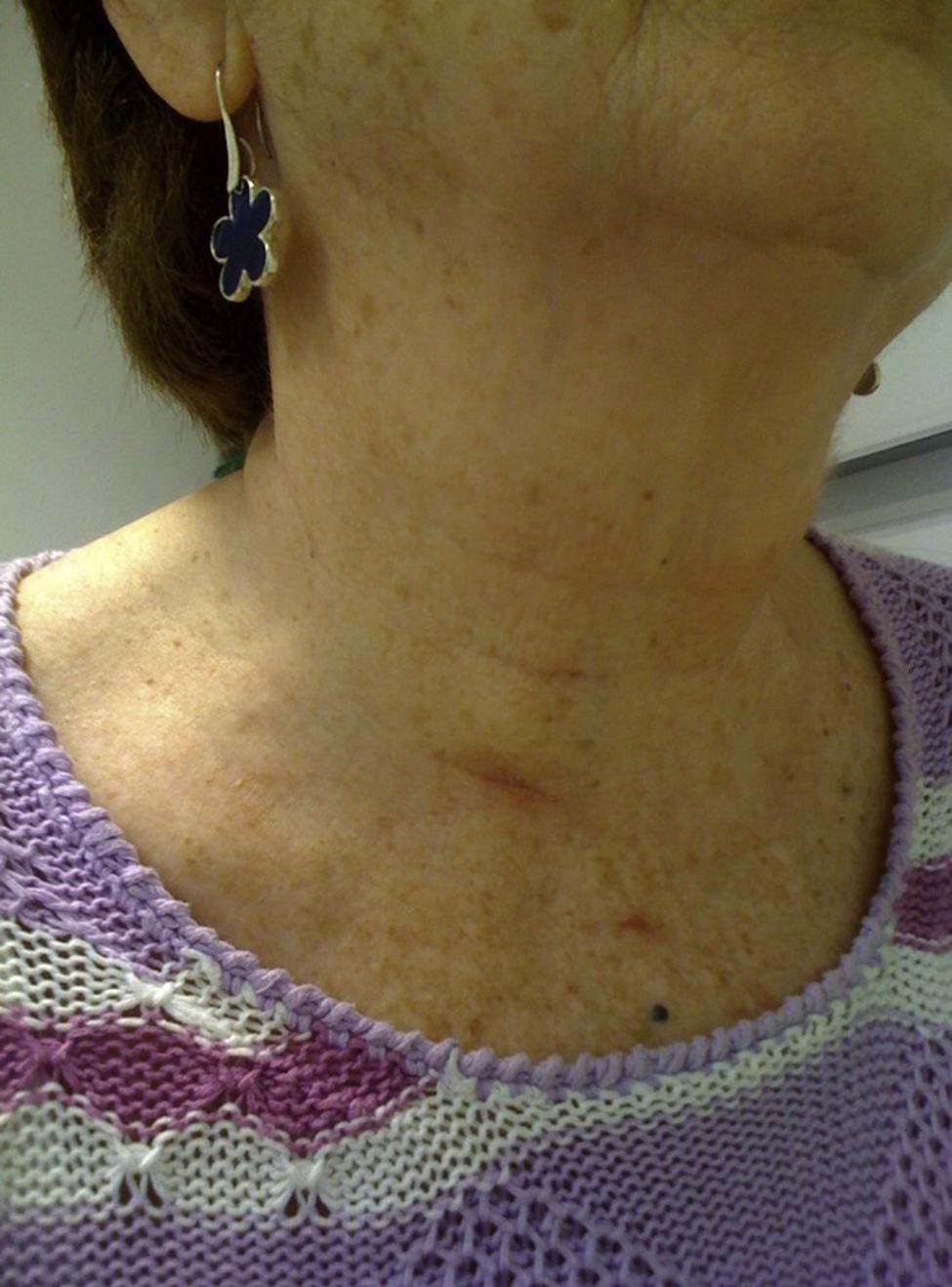 Paratiroidectomía lateral endoscópica en el manejo de pacientes con ...