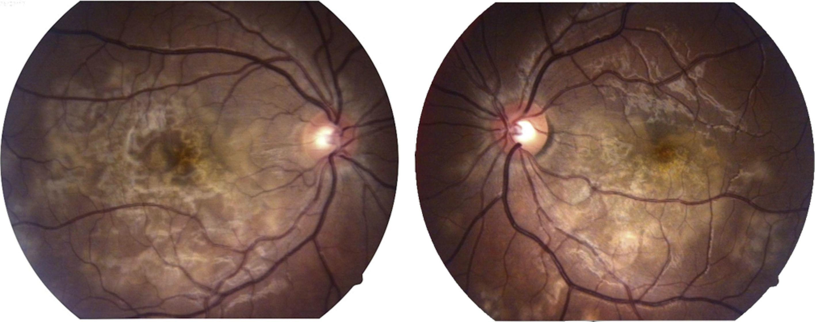 Epiteliopatía pigmentaria placoide multifocal posterior aguda. Reporte ...