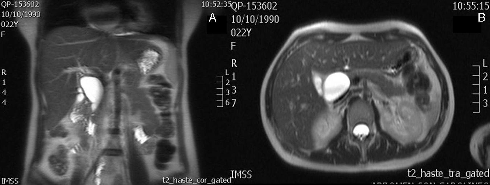 Quiste de colédoco y embarazo. Reporte de 3 casos y revisión de la ...