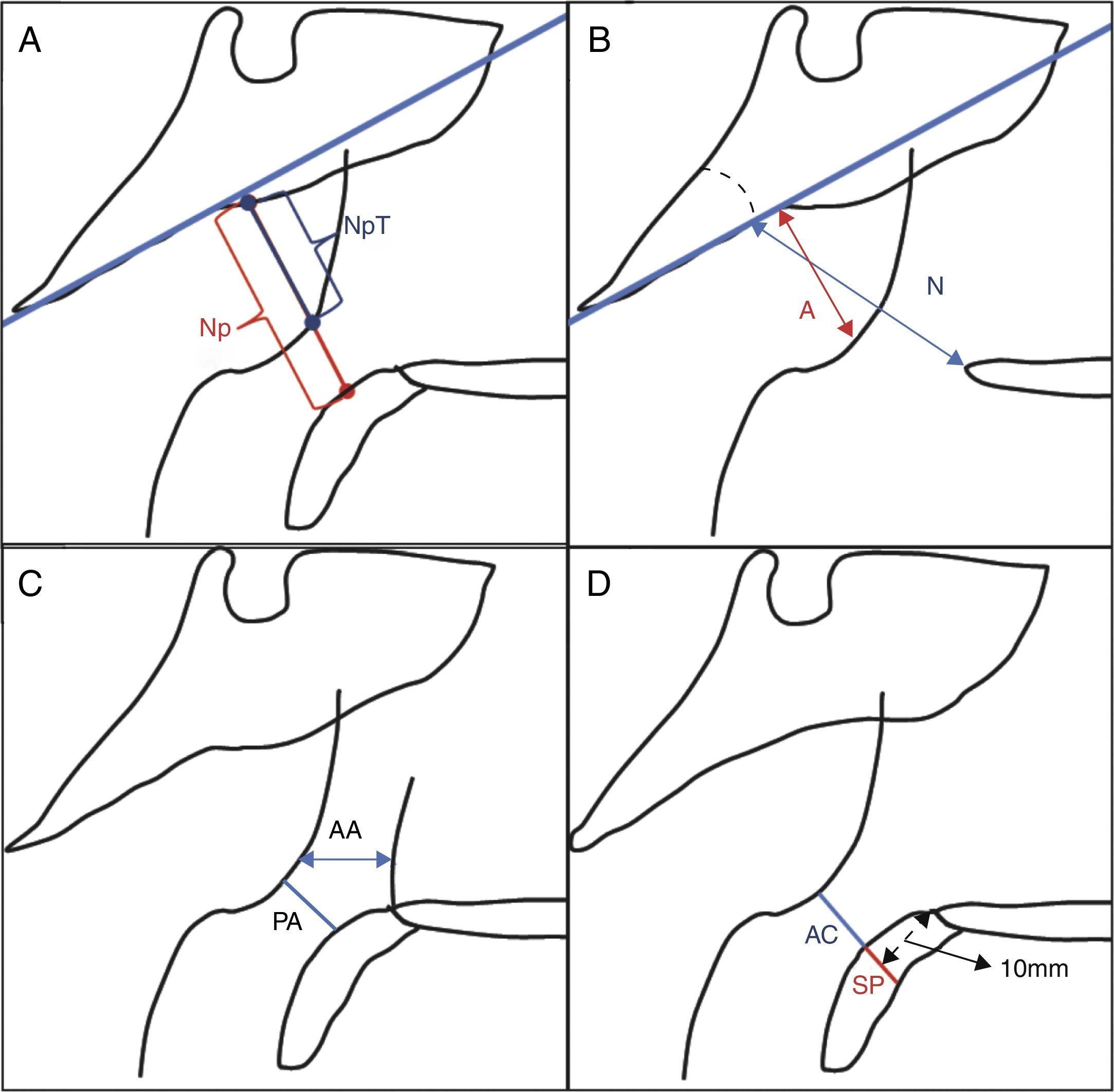 Radiographic adenoid evaluation – suggestion of referral parameters ...