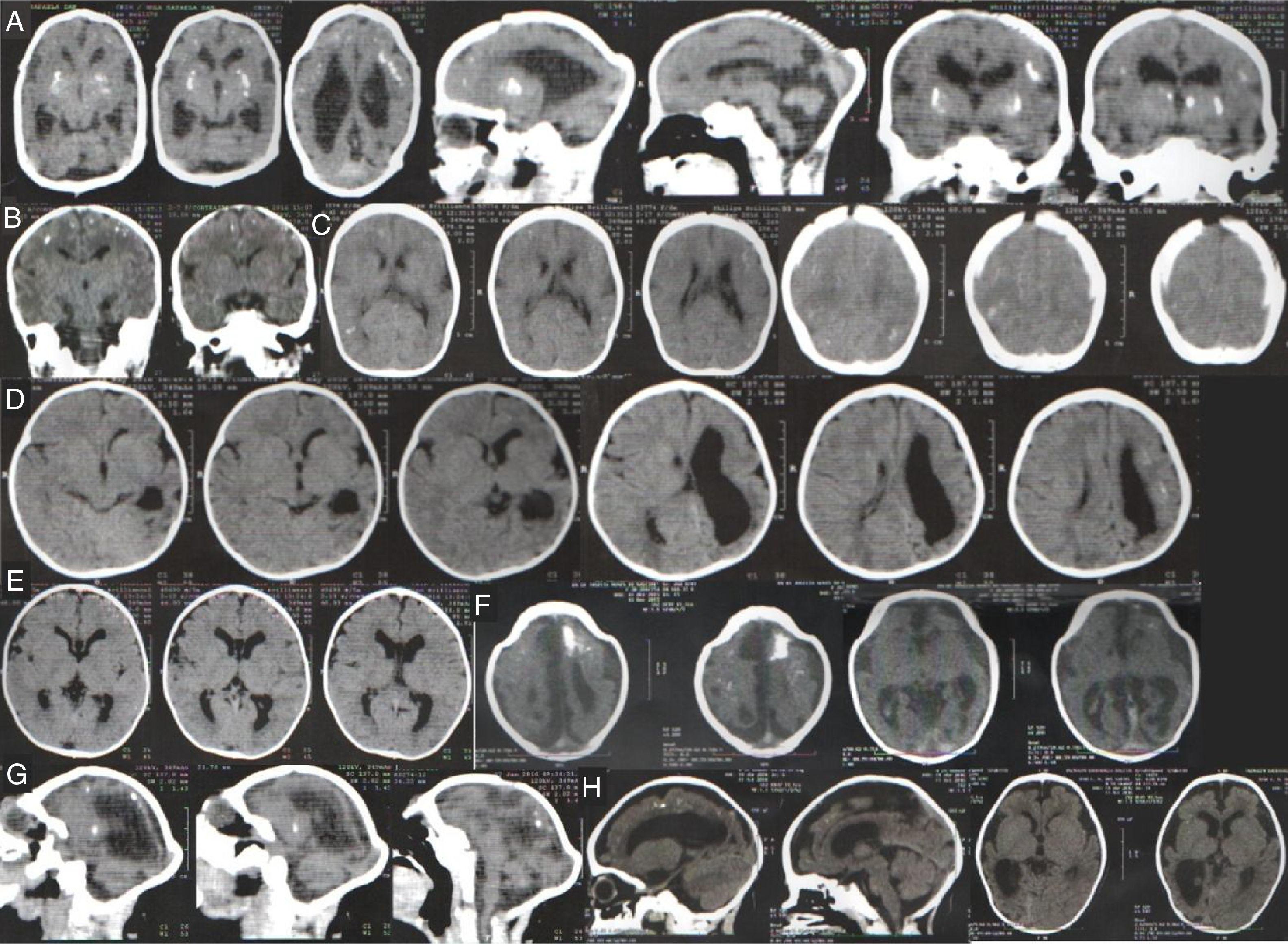 Clinical and epidemiological aspects of microcephaly in the state of ...