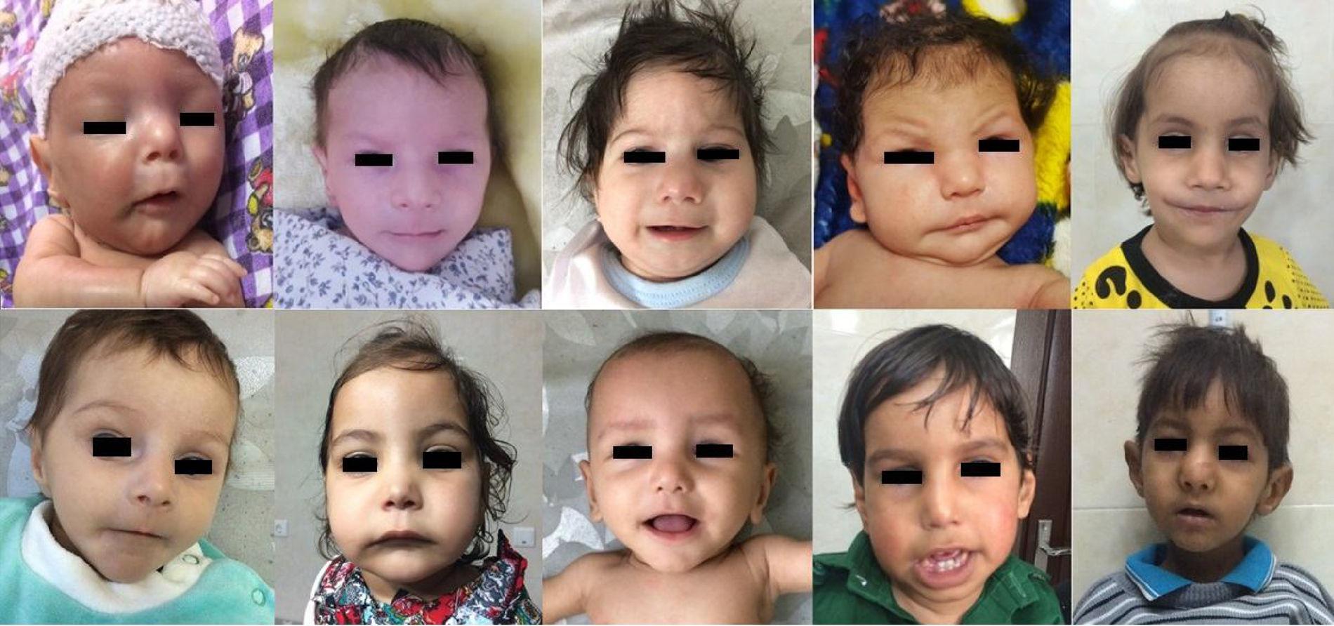 Hypoparathyroidism Patient